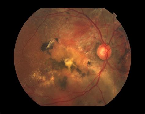 Polypoidal Choroidal Vasculopathy Photograph By Paul Whitten Fine Art