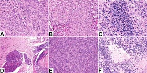 The Histopathological Spectrum Of Human Meningiomas Abstract