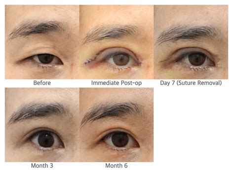 When Does Ptosis Surgery Look Natural Understanding The 6 Month