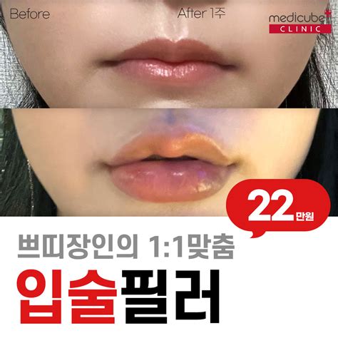 강남 3대 쁘띠장인 입술필러 By 메디큐브의원 강남점 강남언니 1등 성형수술and피부시술 정보앱