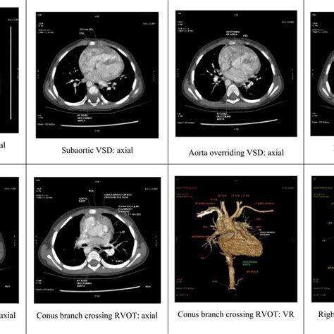 Preparation Of Monocusp Valve In Right Ventricular Outflow Tract Rvot