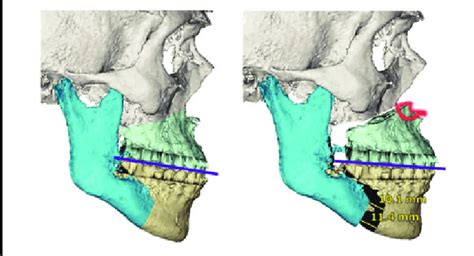 Counterclockwise Rotation Jaw