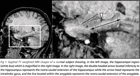 Scielo Brasil Value Of Extent Of Hippocampal Resection In The Surgical Treatment Of Temporal