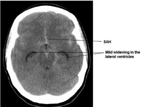 Preoperative Cranial Ct Image Shows Diffuse Sah Edematous Brain And A Download Scientific