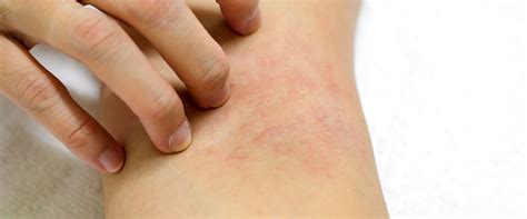 Skin Infections Symptoms Causes And Treatment Rena Clinics