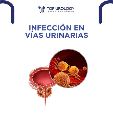 Top Urology Una Infección De Las Vías Urinarias Es Una