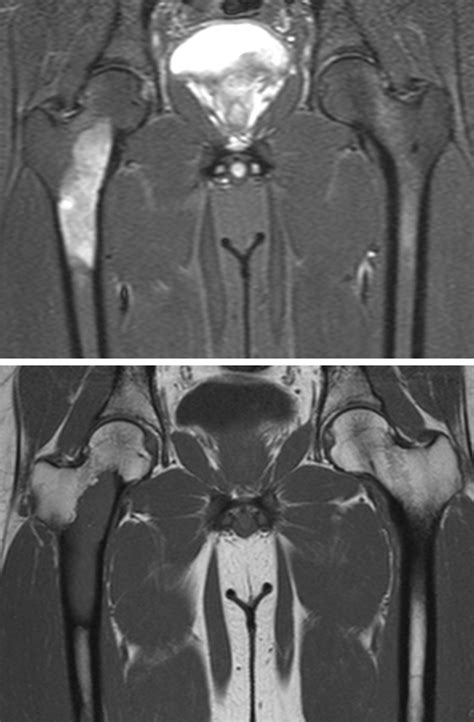 Intracortical Fibrous Dysplasia Dfxdx
