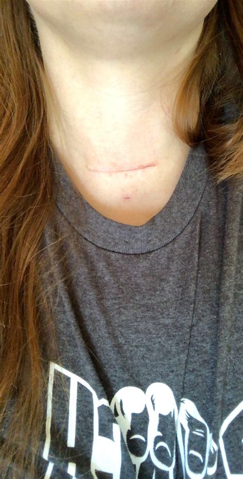 11 Days Post Partial Thyroidectomy R Thyroidcancer