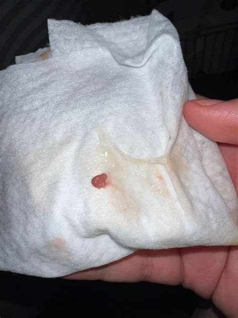 Possible Implantation Bleeding Babycenter