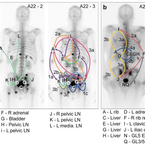 Metastasis To Metastasis Seeding Occurs Either By A Linear Or A
