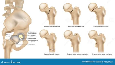 Types Of Proximal Femur Fractures Hip Fracture Types By Anatomical