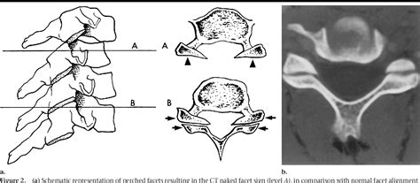 Figure 2 From The Naked Facet Sign Semantic Scholar