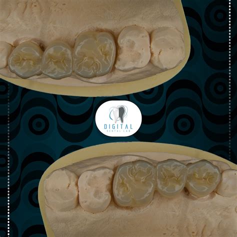 🖌 The Beauty Of Occlusal Staining 🖌 Digital Dental Lab