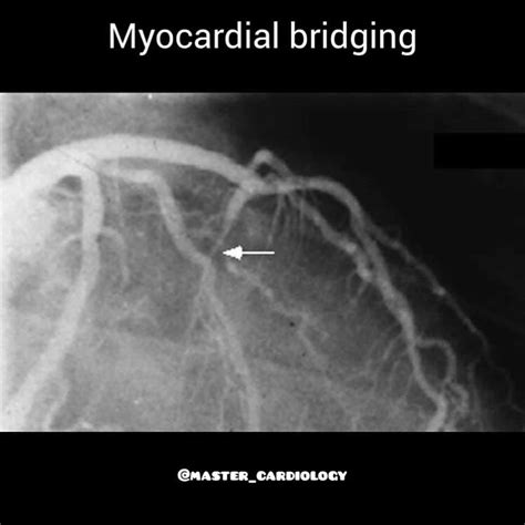 Here Are Some Great Pics And Explanation Of Myocardial Bridging From