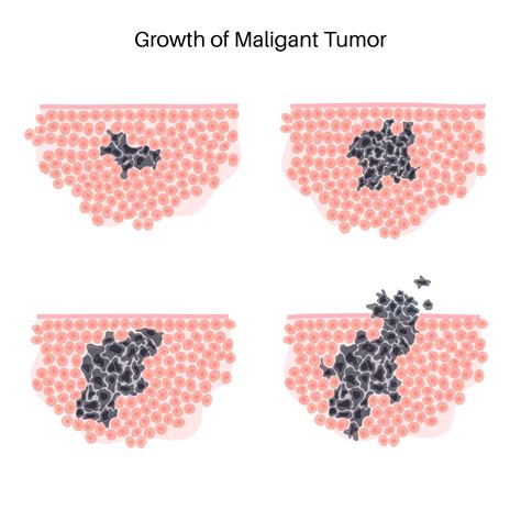Malignant Tumor