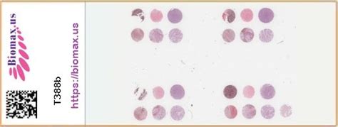 T388b Malignant Melanoma Tissue Array Including Tnm And Clinical Stage