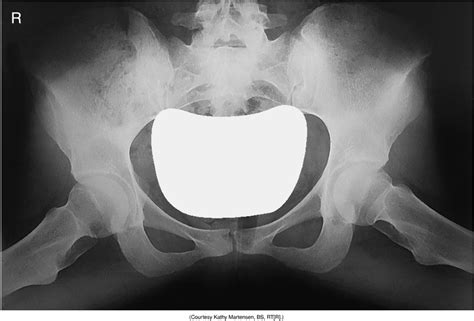 Ap Bilateral Frog Leg Pelvis Diagram Quizlet