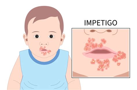 Bébé A De Limpétigo Causes Et Traitements Pour Le Soigner