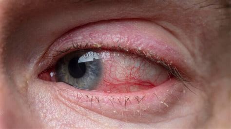 Neurodermitis Am Auge Sanubiom