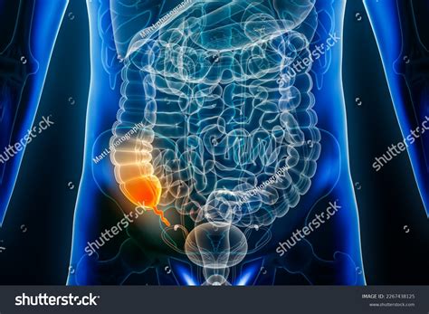 Appendicitis Disease Vermiform Appendix Inflammation 3d Stock Illustration 2267438125 Shutterstock