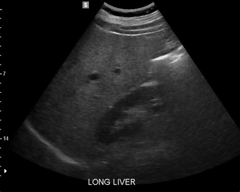 Hepatic Steatosis Radiology Case