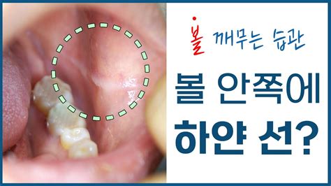 이악물기 볼을 깨무는 습관 볼 안쪽에 하얀 선이 보여요 Youtube