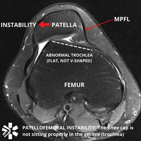 How To Treat Kneecap Dislocations Vishalpai News