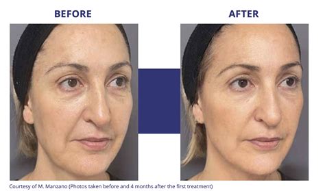 Profhilo Structura Vs Profhilo Treatment Skin To Love Clinic