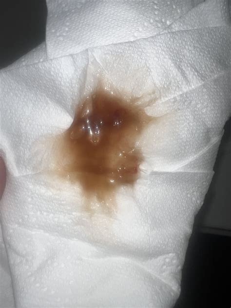 Dark Brown Mucus When Blowing Nose Rsinusitis