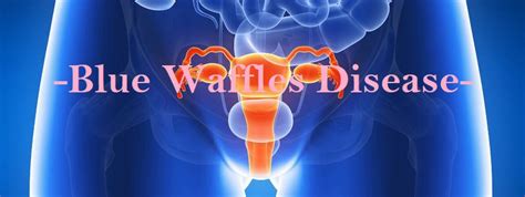 Enfermedad De Los Waffles Azules En Mujeres