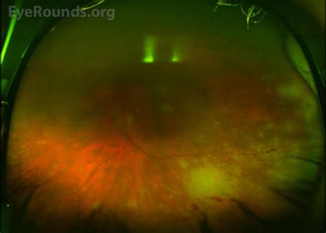 Bilateral Acute Retinal Necrosis