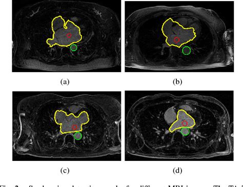 Figure 1 From Automatic Segmentation Of The Left Atrium From Mri Images Using Salient Feature