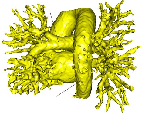 An Example Of Left Atrium Segmentation Classified As C Since It Download Scientific