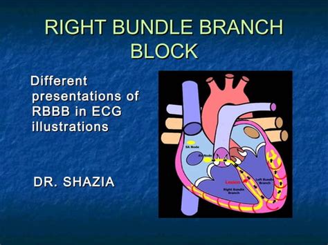 Right Bundle Branch Block PPT