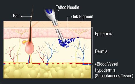 Paciente Eliminación De Tatuajes Candela Medical