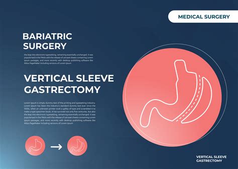 Lap Sleeve Gastrectomy Ncbi At Christy Nathan Blog