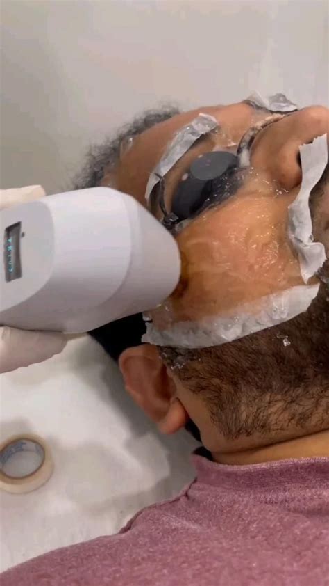 Laser Beard Shaping Beard Shapes Perfect Beard Laser Hair Removal