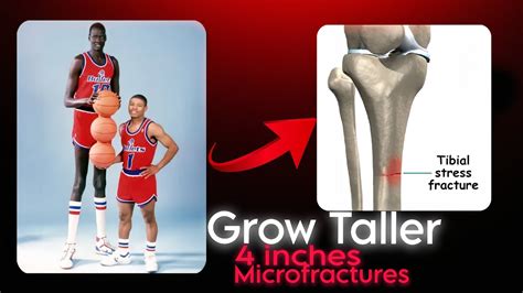 How To Grow Taller At Any Age Using [microfracture Method] Youtube