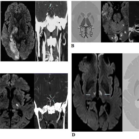 A Vascular Supply Around Tob Artery Ba Pca Sca And Their Branches