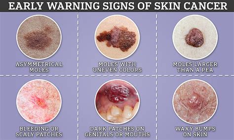 Melanoma Now No Longer The Leading Cause Of Skin Cancer Deaths These