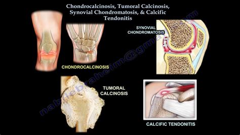 Chondrocalcinosis Tumoral Calcinosis Synovial Chondromatosis And Calcific Tendonitis Youtube