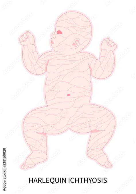 Fetal With Harlequin Ichthyosis Disorder Stock Vector Adobe Stock