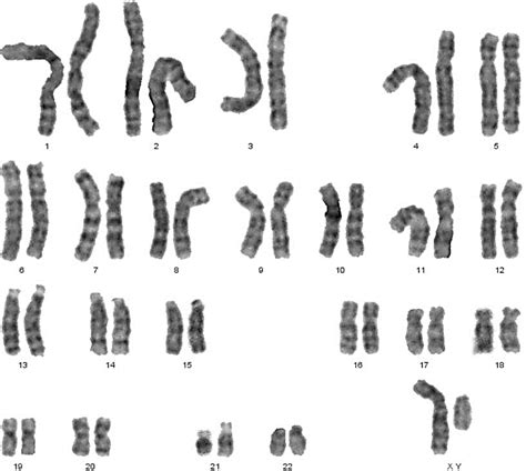 Cytogenetic Screening Of Chromosomal Abnormalities And Genetic Analysis Of Fsh Receptor