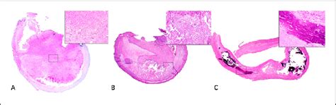Histological Evaluation Of Carotid Artery Plaques Intraplaque Download Scientific Diagram