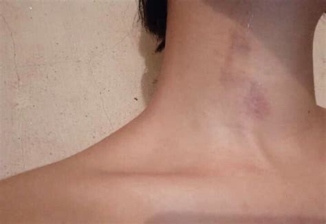 Bite Marks On Neck Tumblr