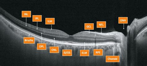 Macular Oct Greatly Improves Pre Op Cataract Assessment