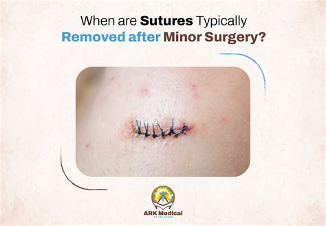 When Are Sutures Typically Removed After Minor Surgery