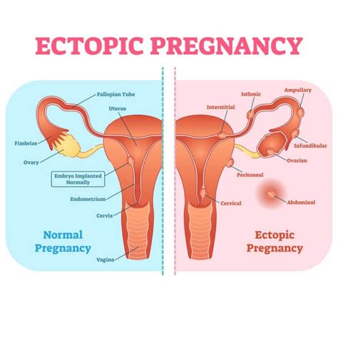 Ectopic Pregnancy Diagram Uncommon Implantation Sites Of Ectopic