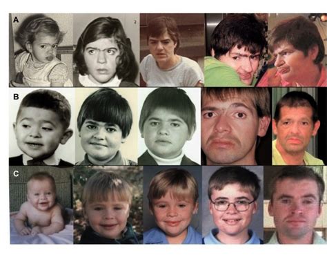 Kleefstra Syndrome Medlineplus Genetics
