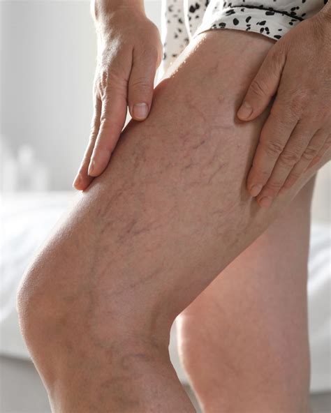 Como Tirar Varizes Guia Completo 2025 Dra Lara Poltronieri